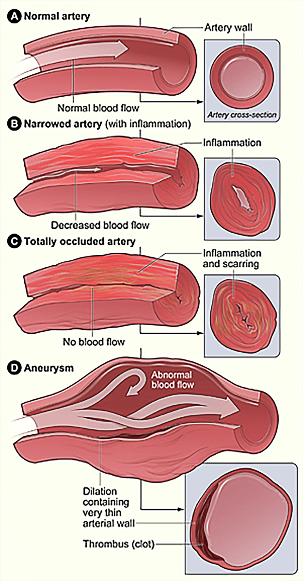 Vasculitis - Estecharat